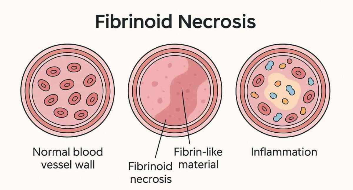 Irreversible Cell Injury & Necrosis: Types, Mechanisms, Morphology and ...
