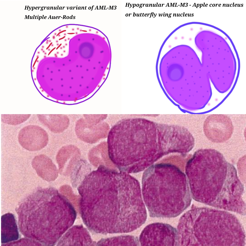 FLT-3- ITD mutations in AML Archives - Pathology for all
