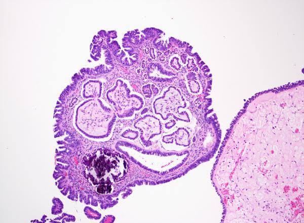 Type I vs. Type II Serous Ovarian Cancers: Pathogenesis and Progression ...