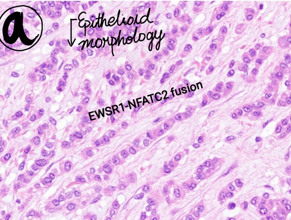 Undifferentiated small round cell sarcomas of bone and soft tissues ...
