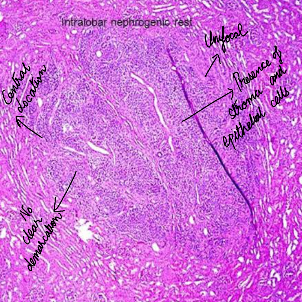 5 Differences between perilobar and intralobar nephrogenic rests ...
