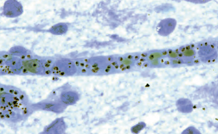 Pathology MCQs for various entrance exams
