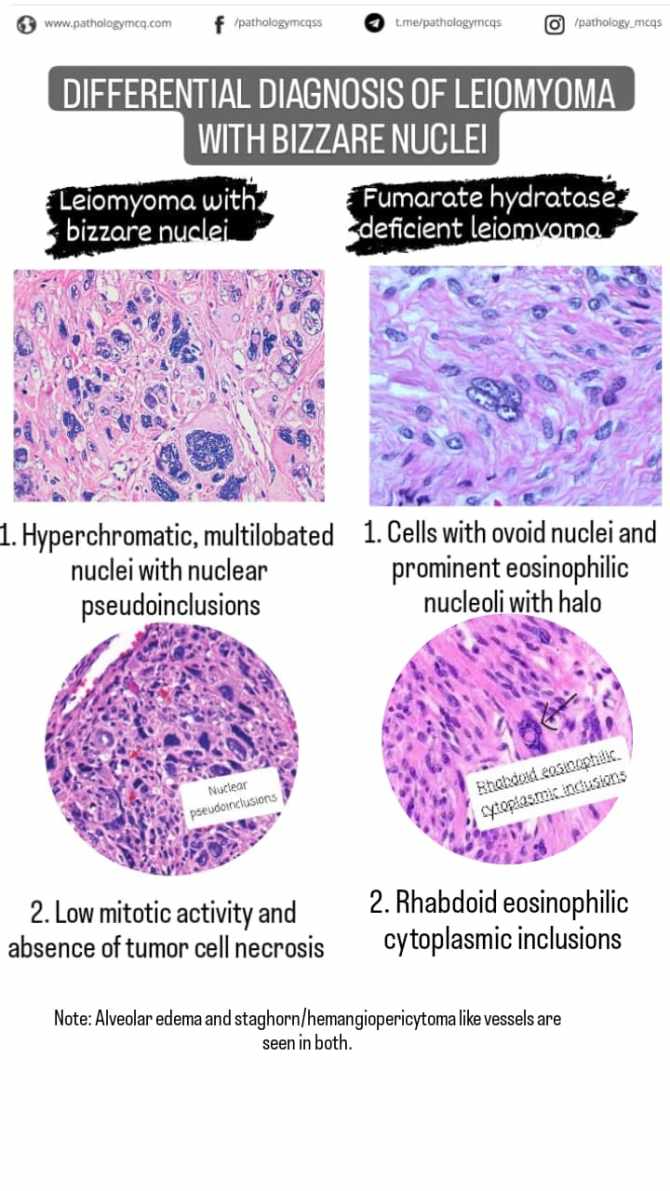 CAN YOU GUESS THE TYPE OF LEIOMYOMA BASED ON THE MORPHOLOGY ...