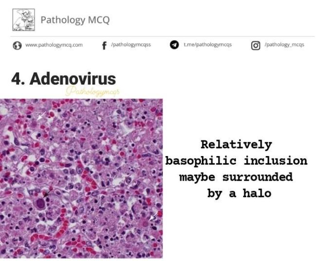 NUCLEAR INCLUSIONS AND PSEUDO-INCLUSIONS - PATHOLOGY MCQs