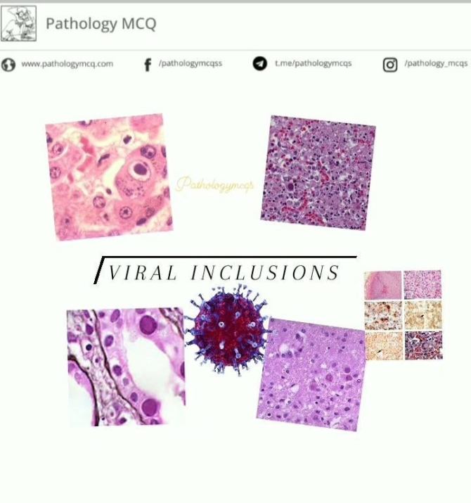 NUCLEAR INCLUSIONS AND PSEUDO-INCLUSIONS - PATHOLOGY MCQs