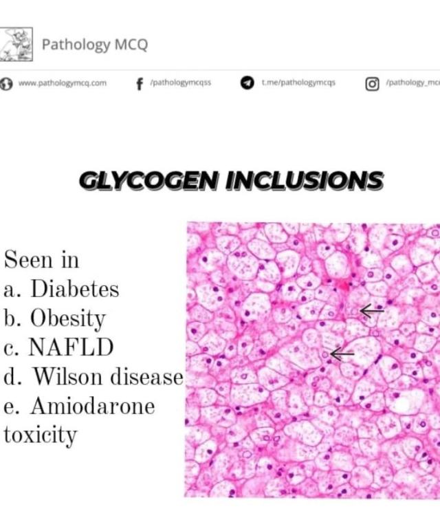 NUCLEAR INCLUSIONS AND PSEUDO-INCLUSIONS - PATHOLOGY MCQs