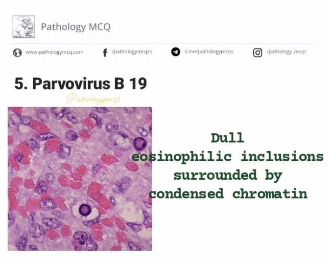 NUCLEAR INCLUSIONS AND PSEUDO-INCLUSIONS - PATHOLOGY MCQs