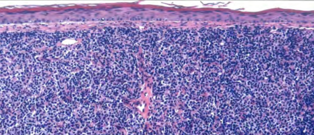 B-cell CLPD - PATHOLOGY MCQs
