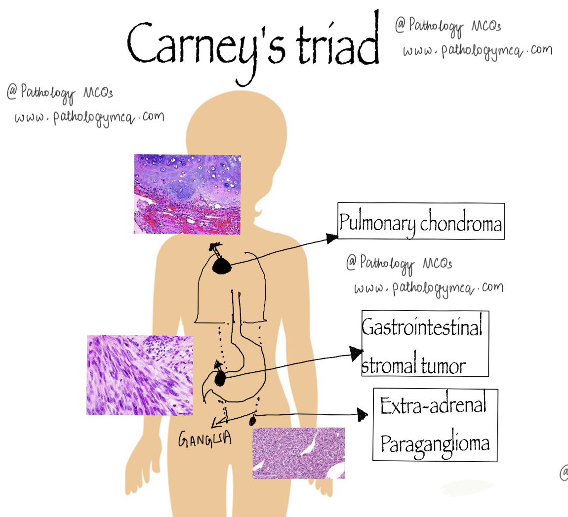 Carney’s confusion - PATHOLOGY MCQs