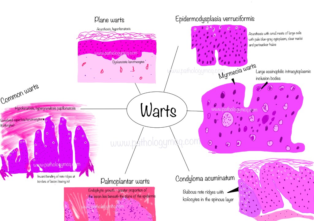 HISTOPATHOLOGIC FINDINGS OF WARTS - SUMMARY - PATHOLOGY MCQs
