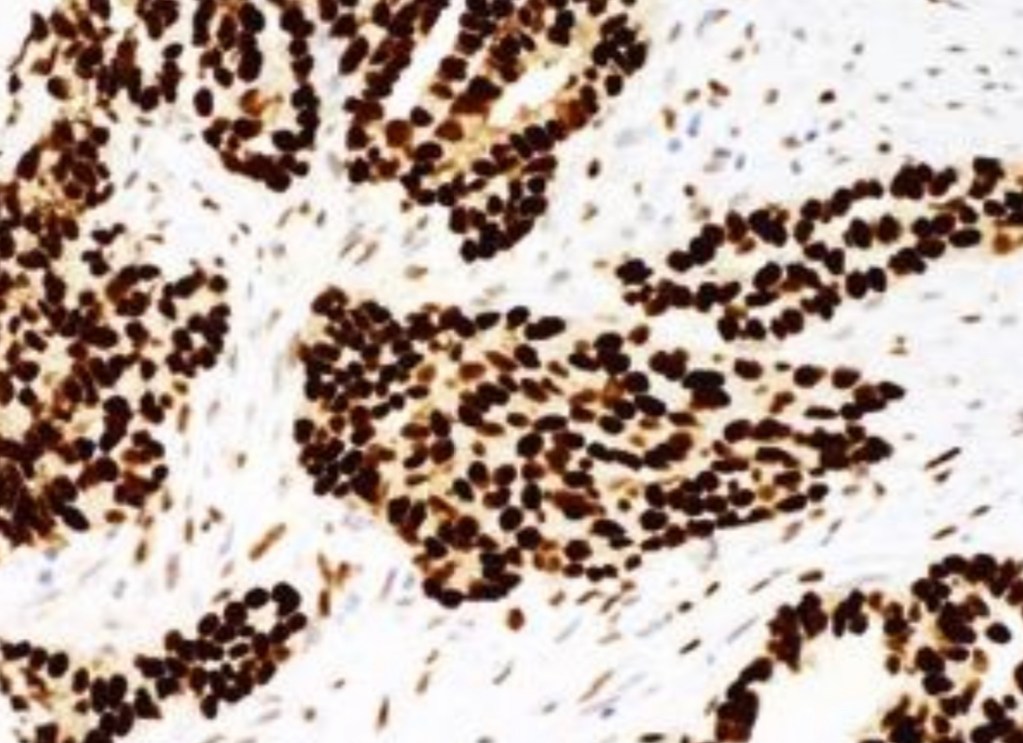 Understanding p53 IHC: Wild Type Pattern vs Mutant type pattern ...