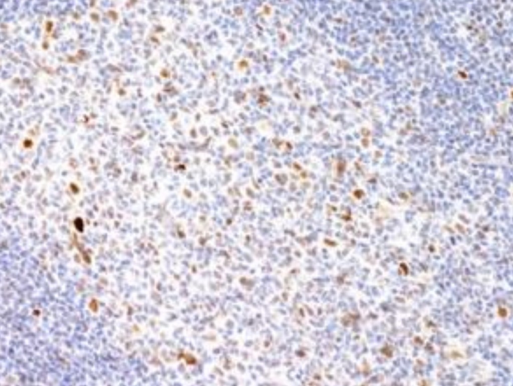 Understanding p53 IHC: Wild Type Pattern vs Mutant type pattern ...