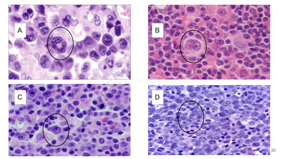 Some differences between Reed- sternberg (RS) cells and RS-like cells ...