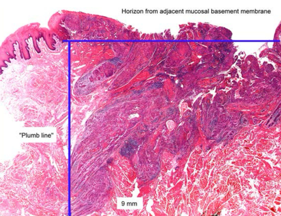 Worst Pattern of Invasion (WPOI) in Oral Squamous Cell Carcinoma ...