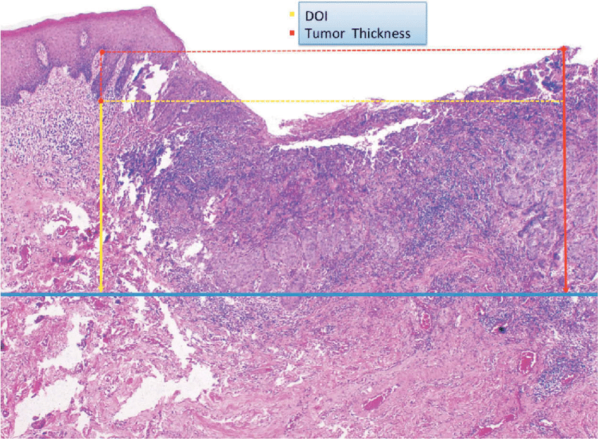 Worst Pattern of Invasion (WPOI) in Oral Squamous Cell Carcinoma ...