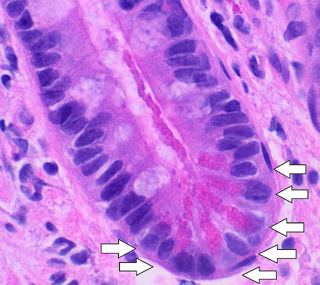Paneth cells and Paneth cell metaplasia- Significance - PATHOLOGY MCQs