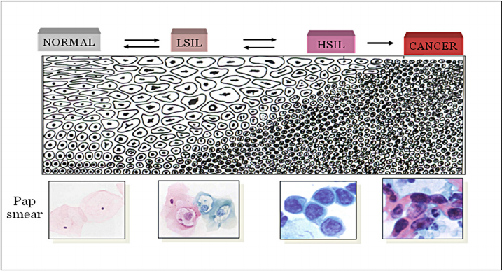 Understanding the Histopathologic Variants of Cervical Carcinomas and ...