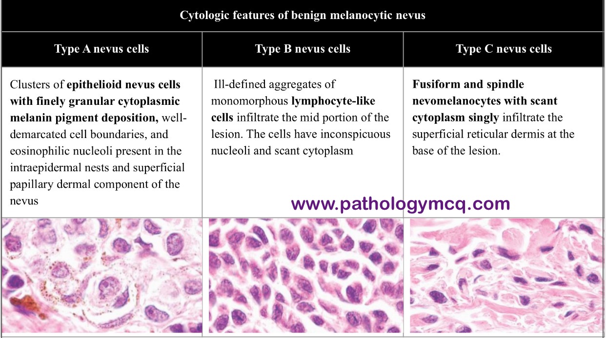 Histologic Variations of Nevus: Intradermal, Junctional, and Compound ...