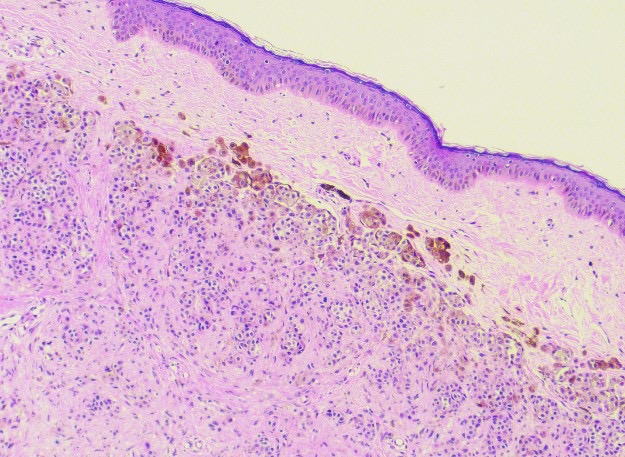Histologic Variations of Nevus: Intradermal, Junctional, and Compound ...