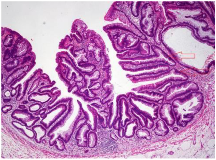 Unraveling Serrated Polyps of the Intestine: A Comprehensive Guide ...