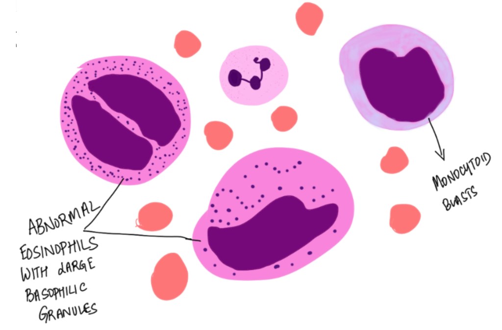 MORPHOLOGY AND GENETICS - QUICK CORRELATION IN ACUTE MYELOID LEUKEMIAS ...