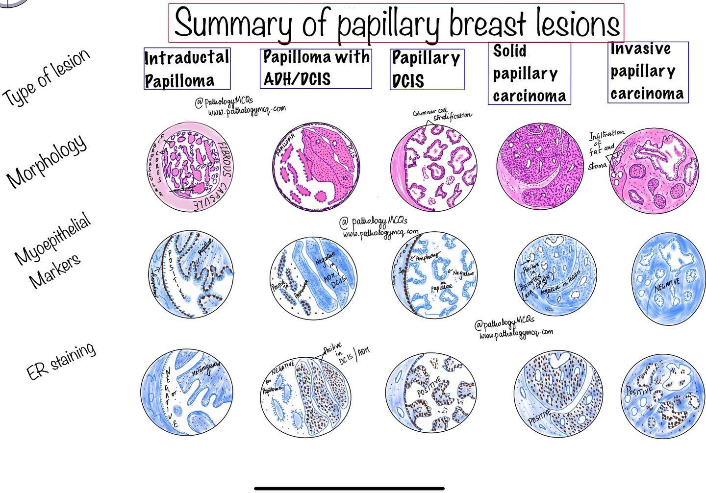 Understanding Papillary Breast Lesions: A Comprehensive Overview ...