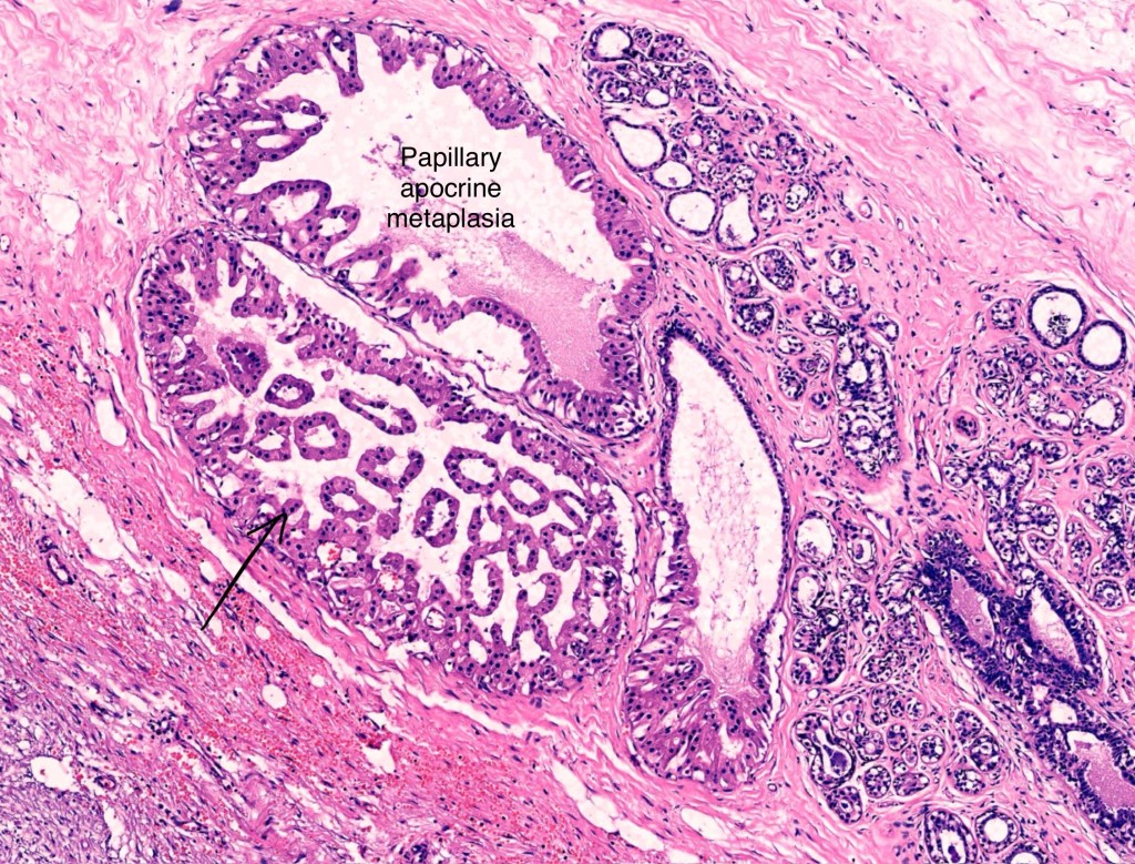 Complex fibroadenoma- Key Features - PATHOLOGY MCQs