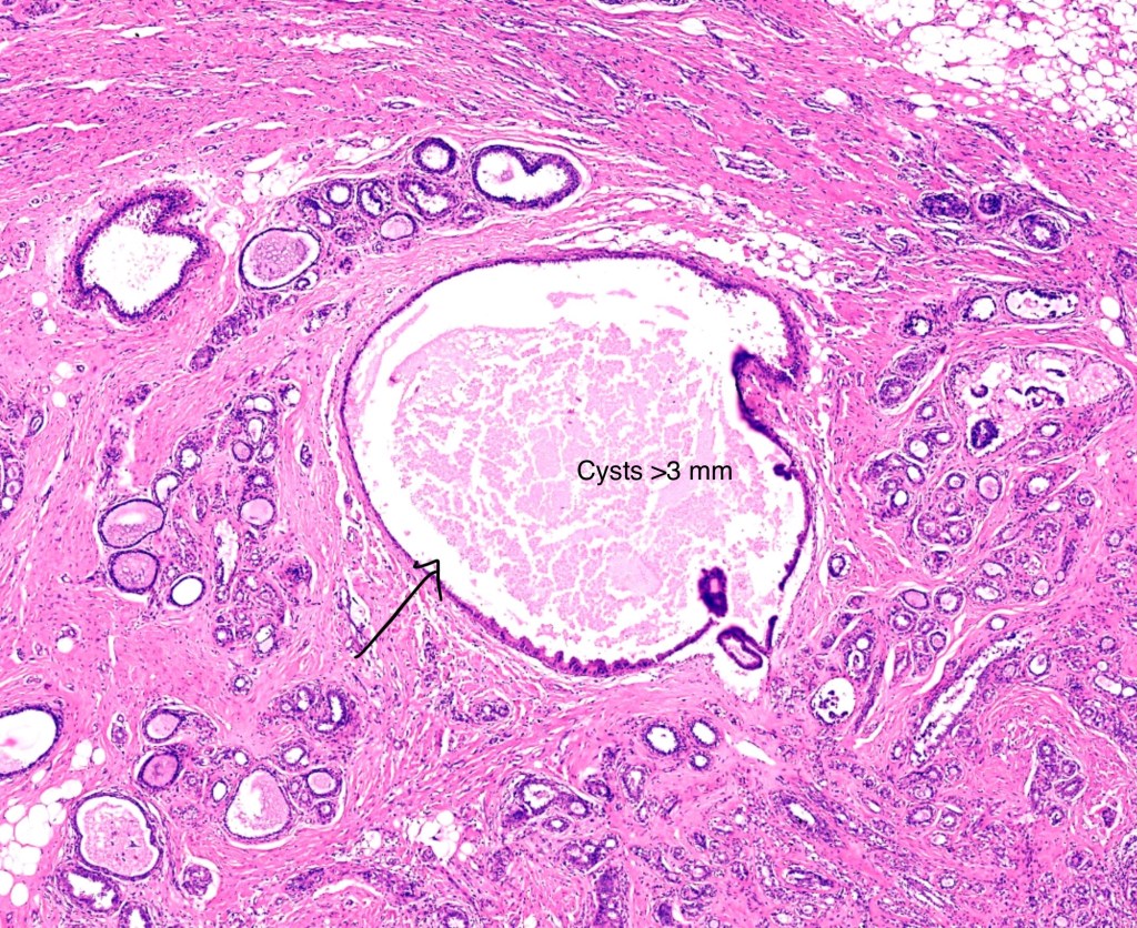 Complex fibroadenoma- Key Features - PATHOLOGY MCQs
