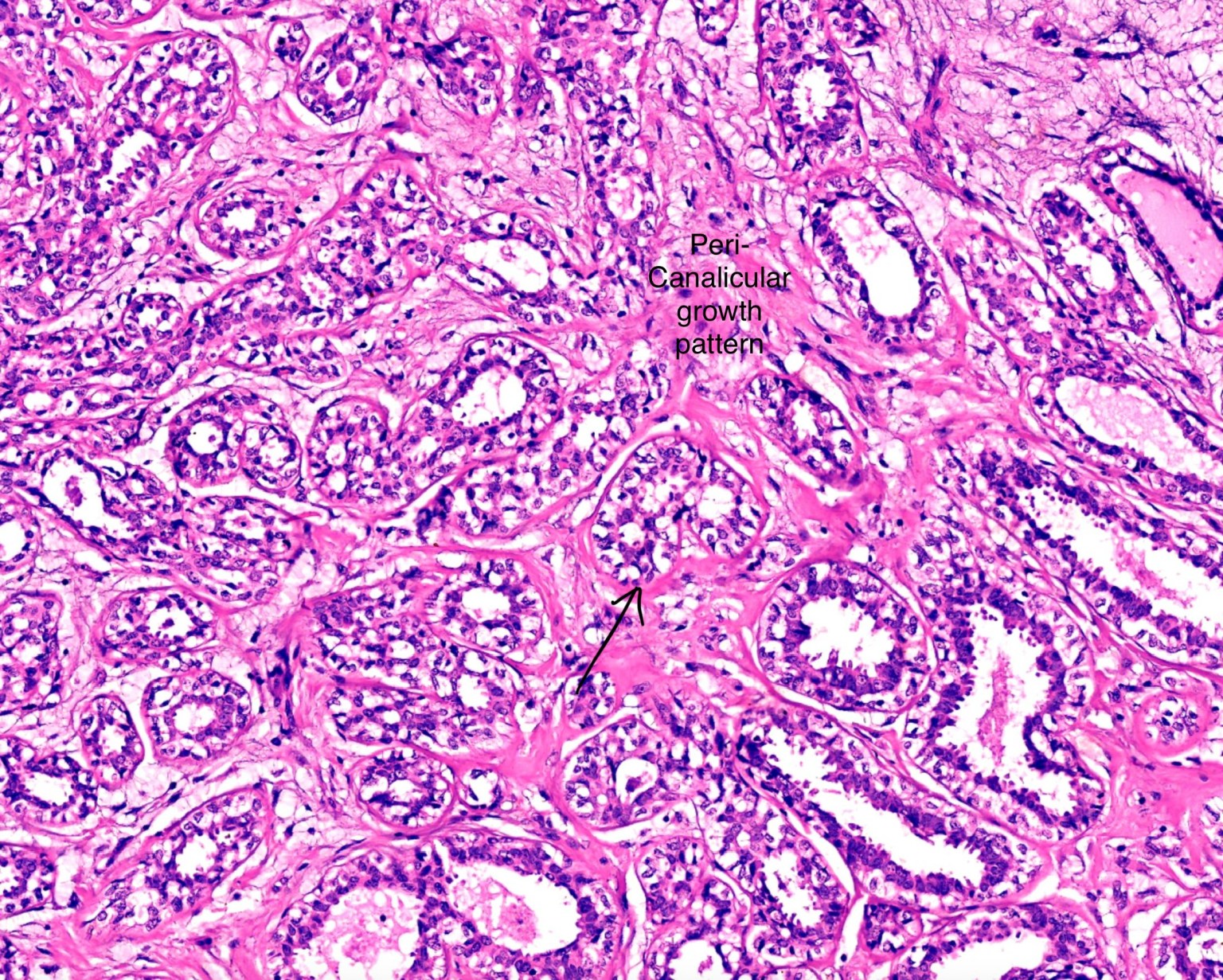 Complex fibroadenoma- Key Features - PATHOLOGY MCQs