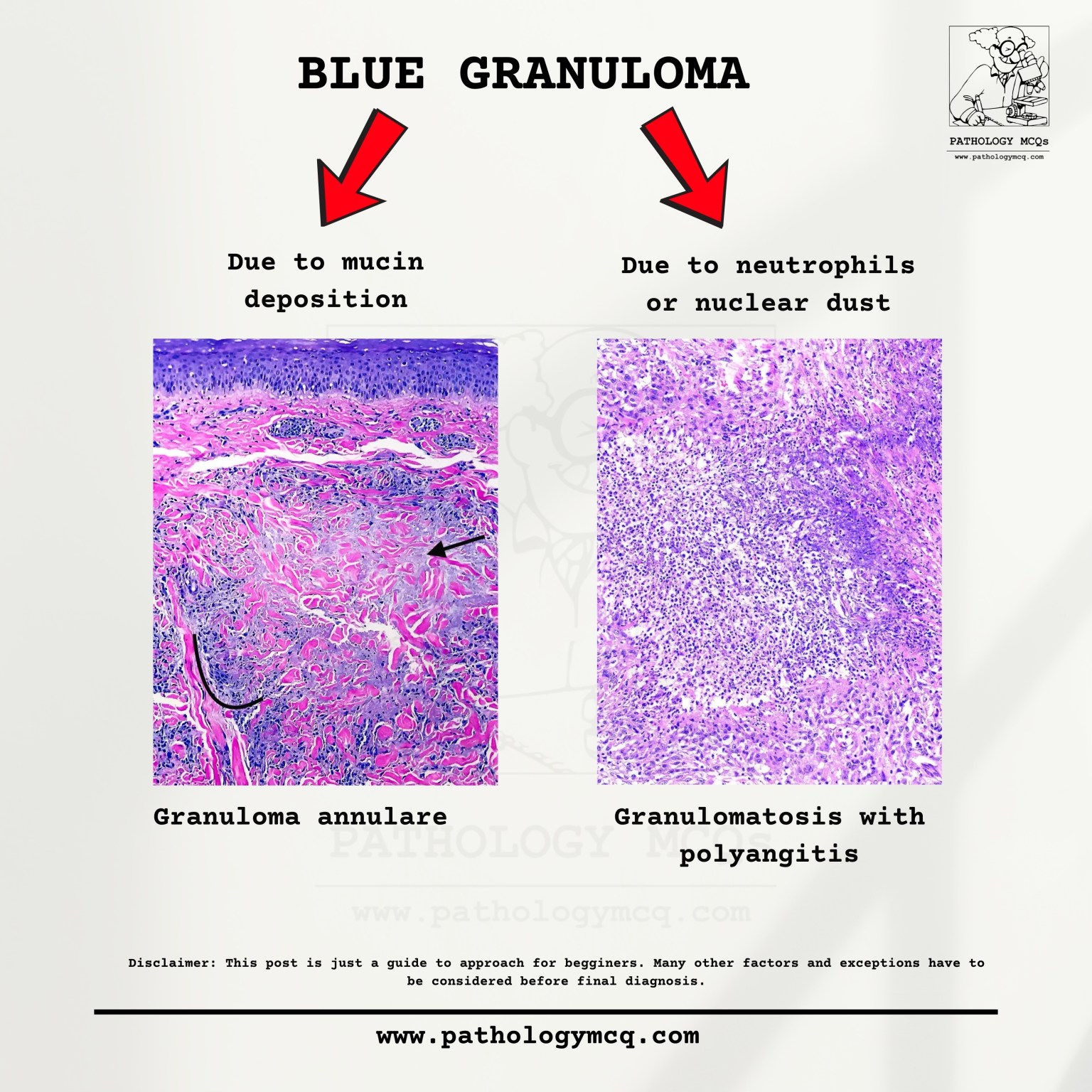 Palisading Granulomas of the Skin: Histological Insights - PATHOLOGY MCQs
