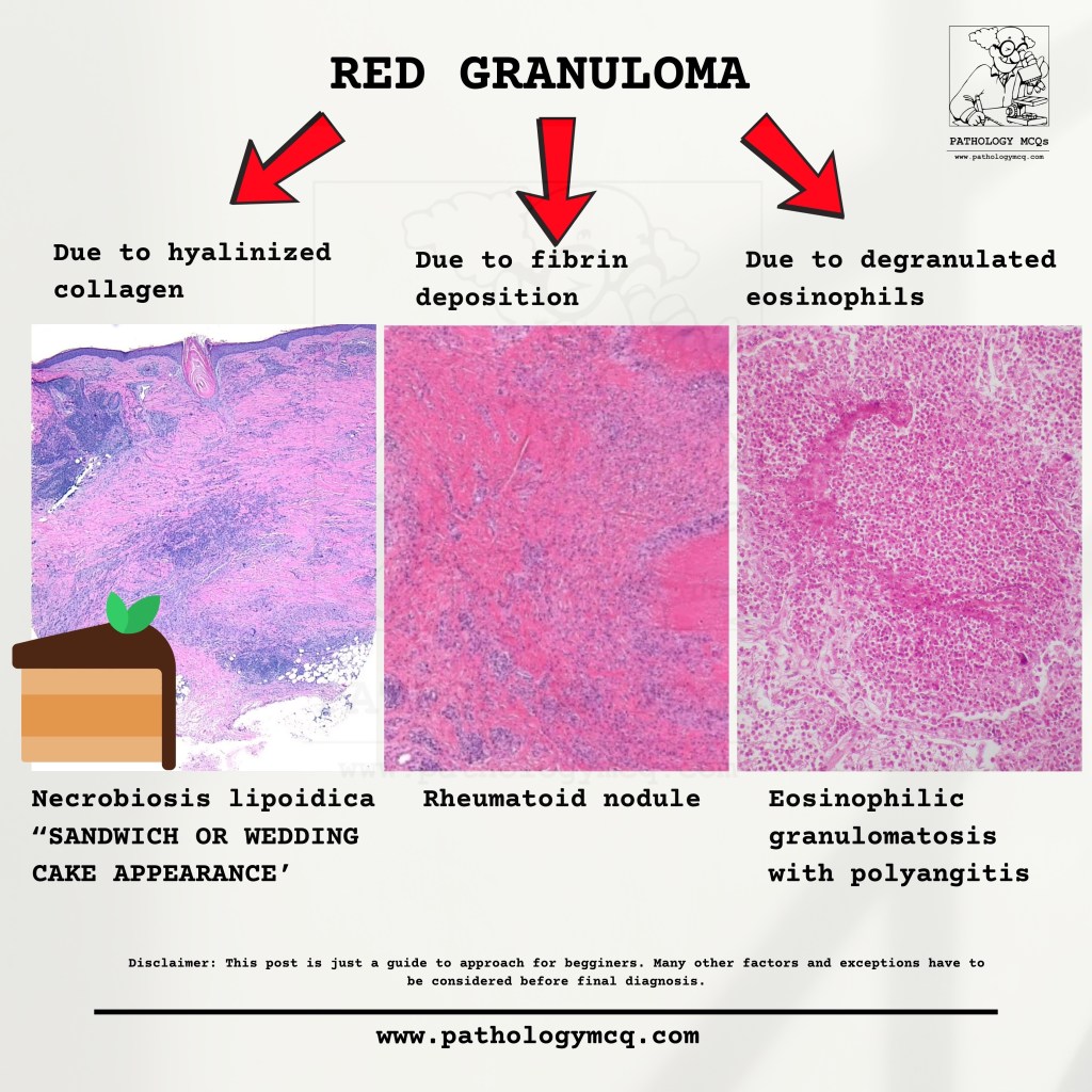 Palisading Granulomas of the Skin: Histological Insights - PATHOLOGY MCQs