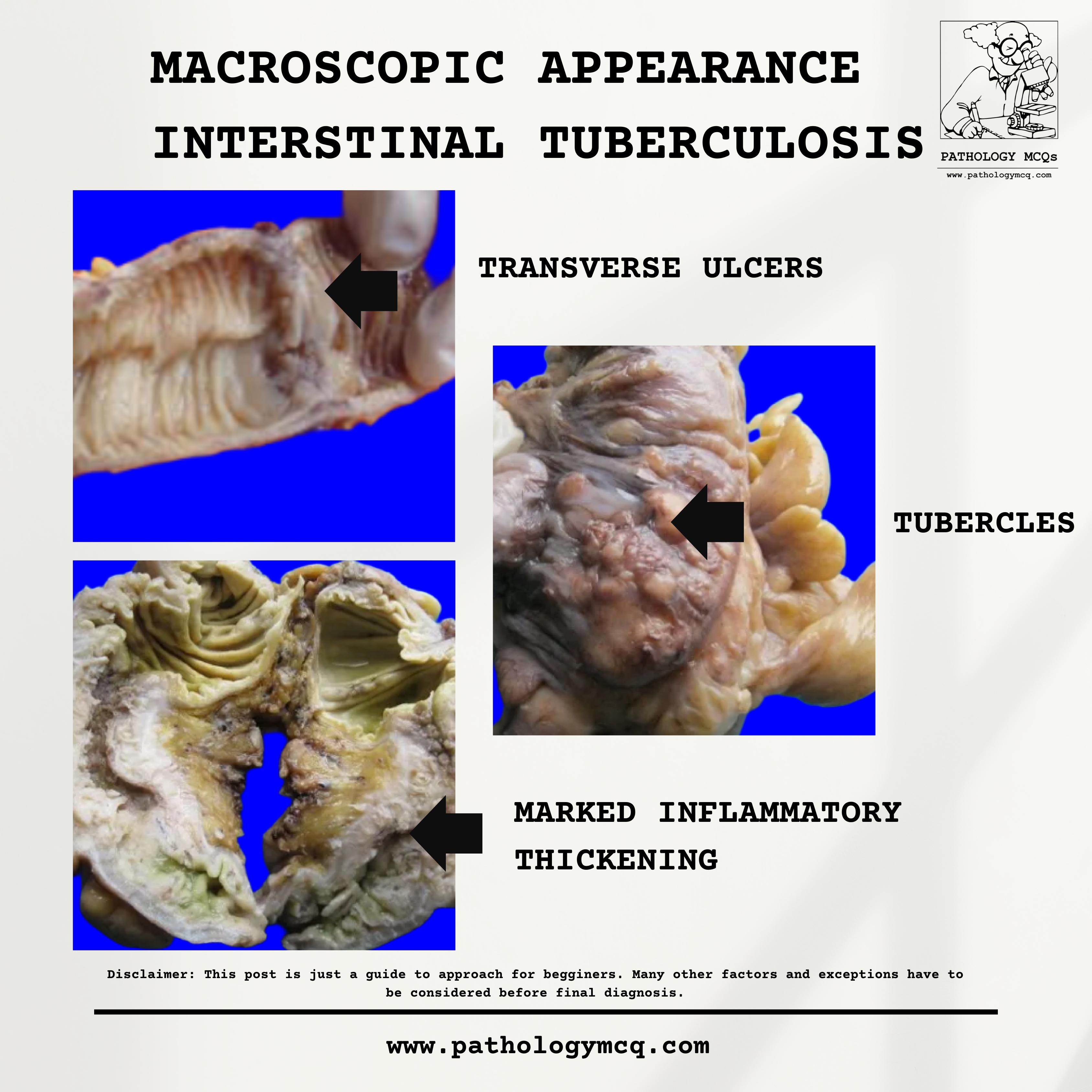 Differentiating Intestinal Tuberculosis from Crohn’s Disease: A ...