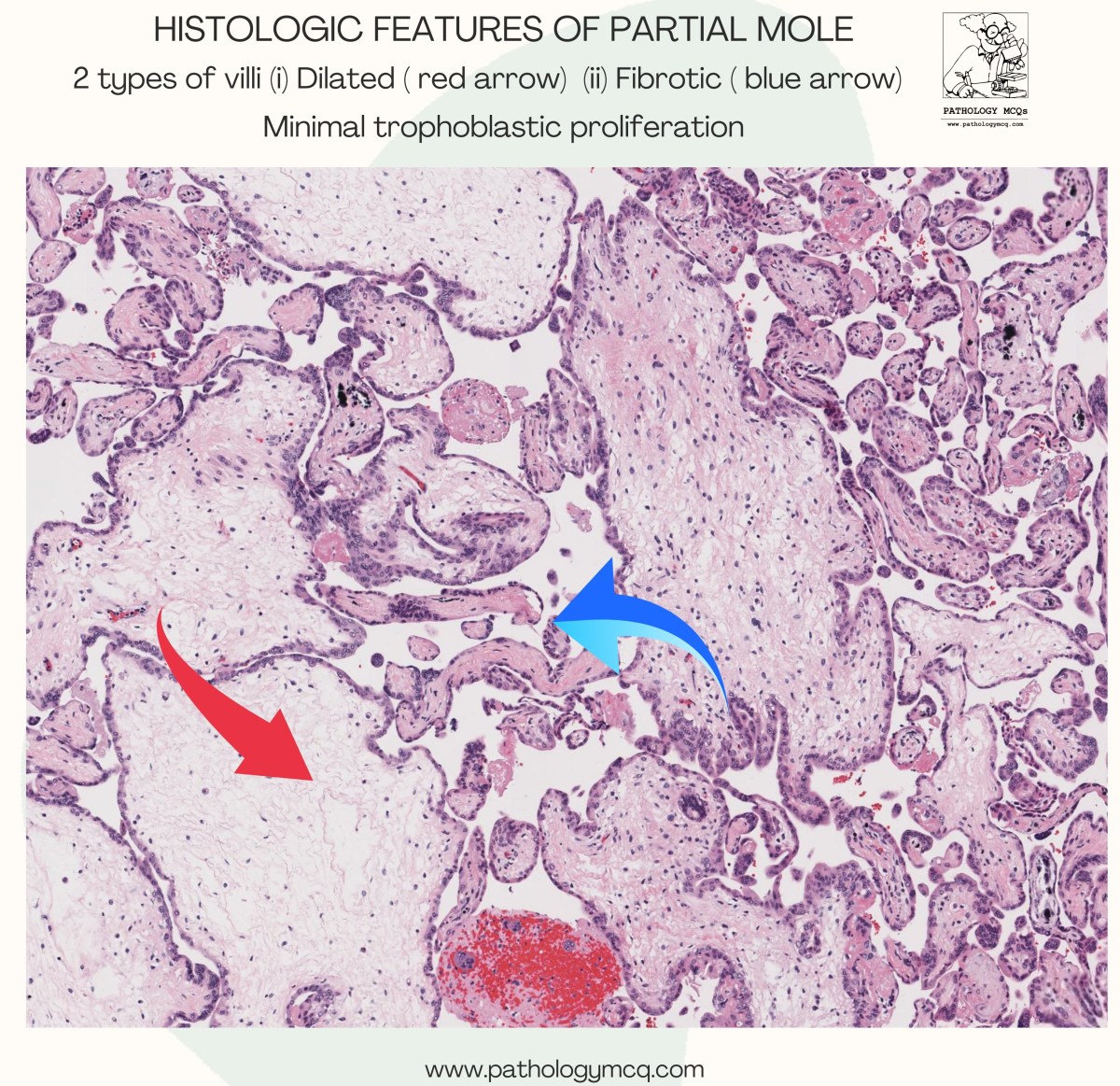 Understanding p57 in Molar Pregnancy: Histopathology and Diagnostic ...