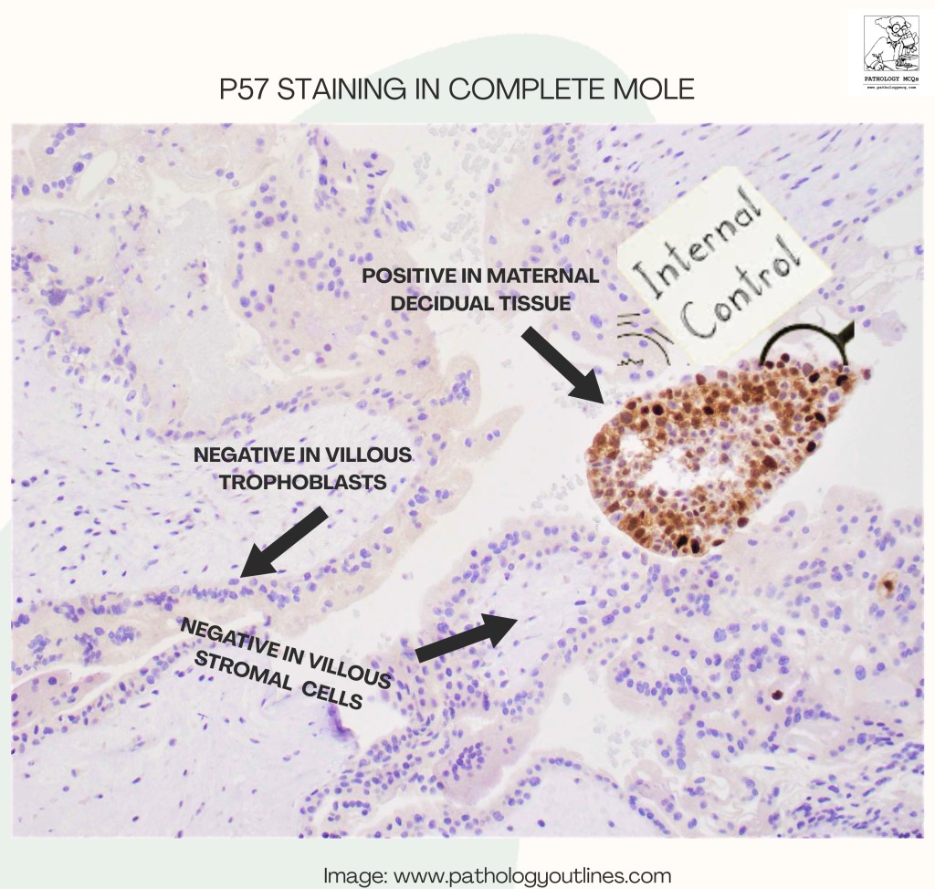 Understanding p57 in Molar Pregnancy: Histopathology and Diagnostic ...