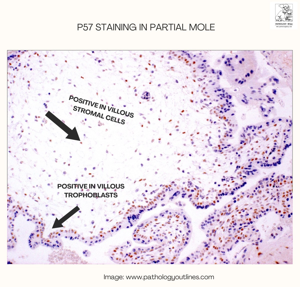 Understanding p57 in Molar Pregnancy: Histopathology and Diagnostic ...