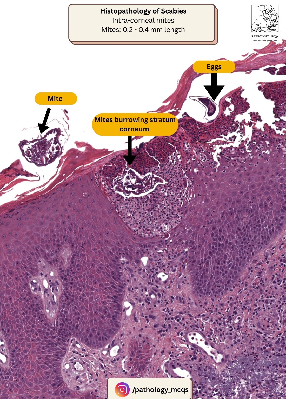 Histopathology of Scabies - PATHOLOGY MCQs