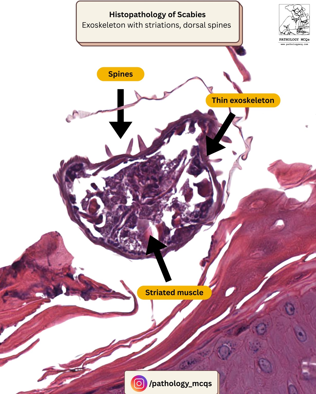 Histopathology of Scabies - PATHOLOGY MCQs