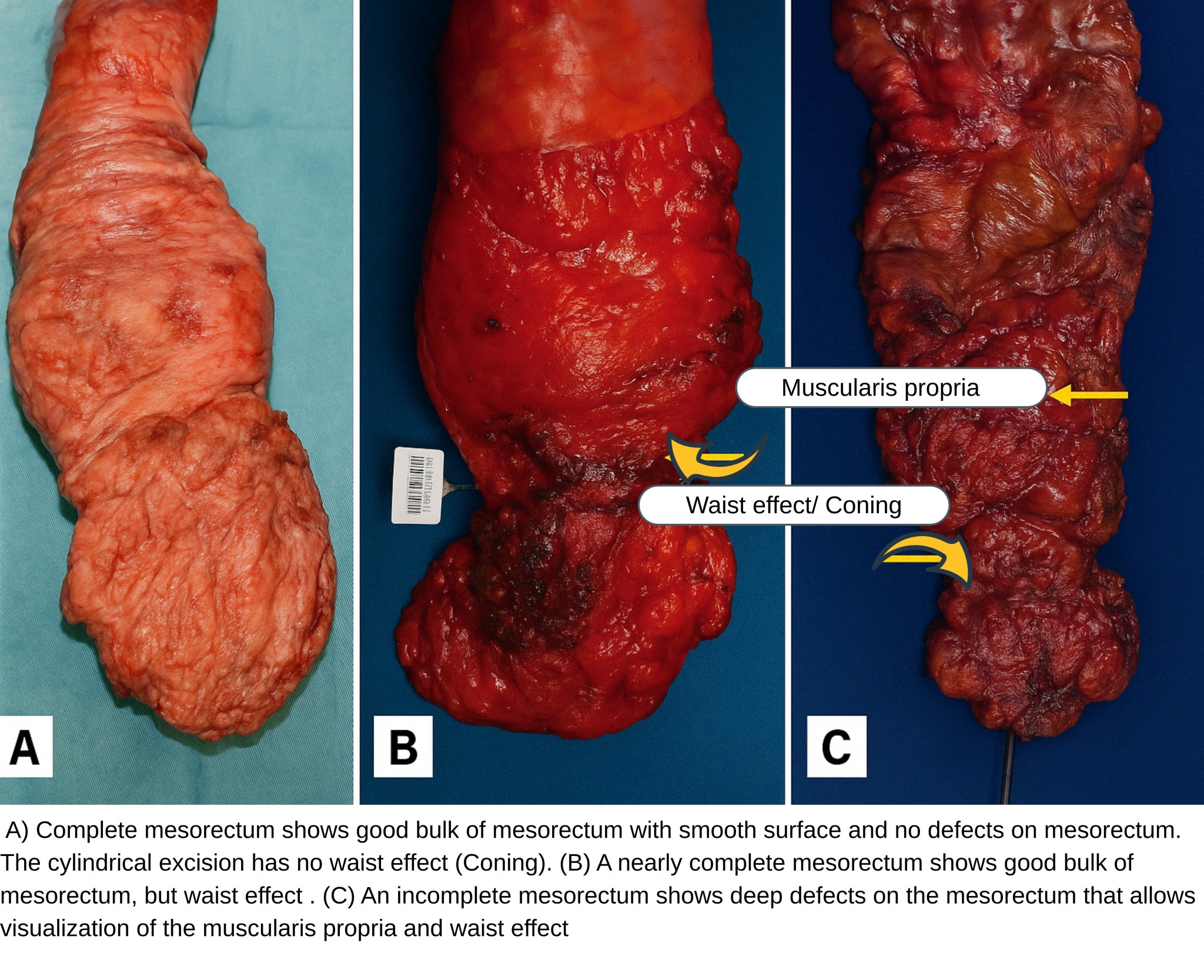Total Mesorectal Excision (TME) – Grossing essentials for Pathologists ...