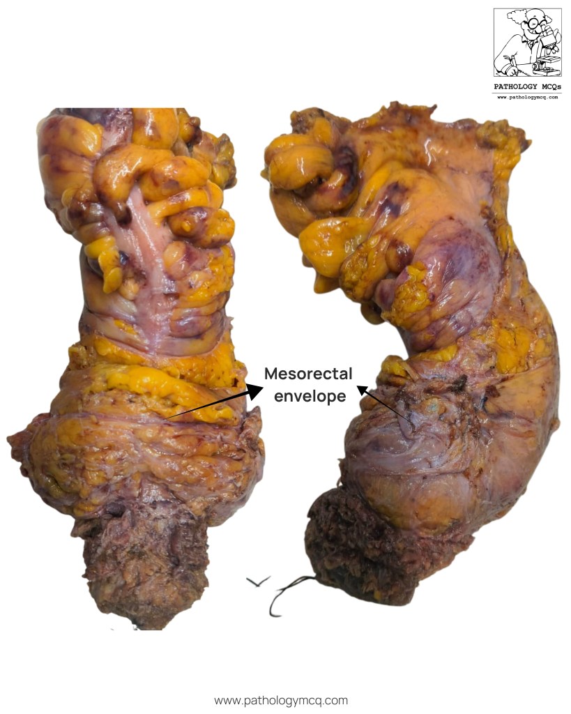 🧾 Gross Pearls: Anatomy & Surgical Resection of the Rectum - PATHOLOGY MCQs
