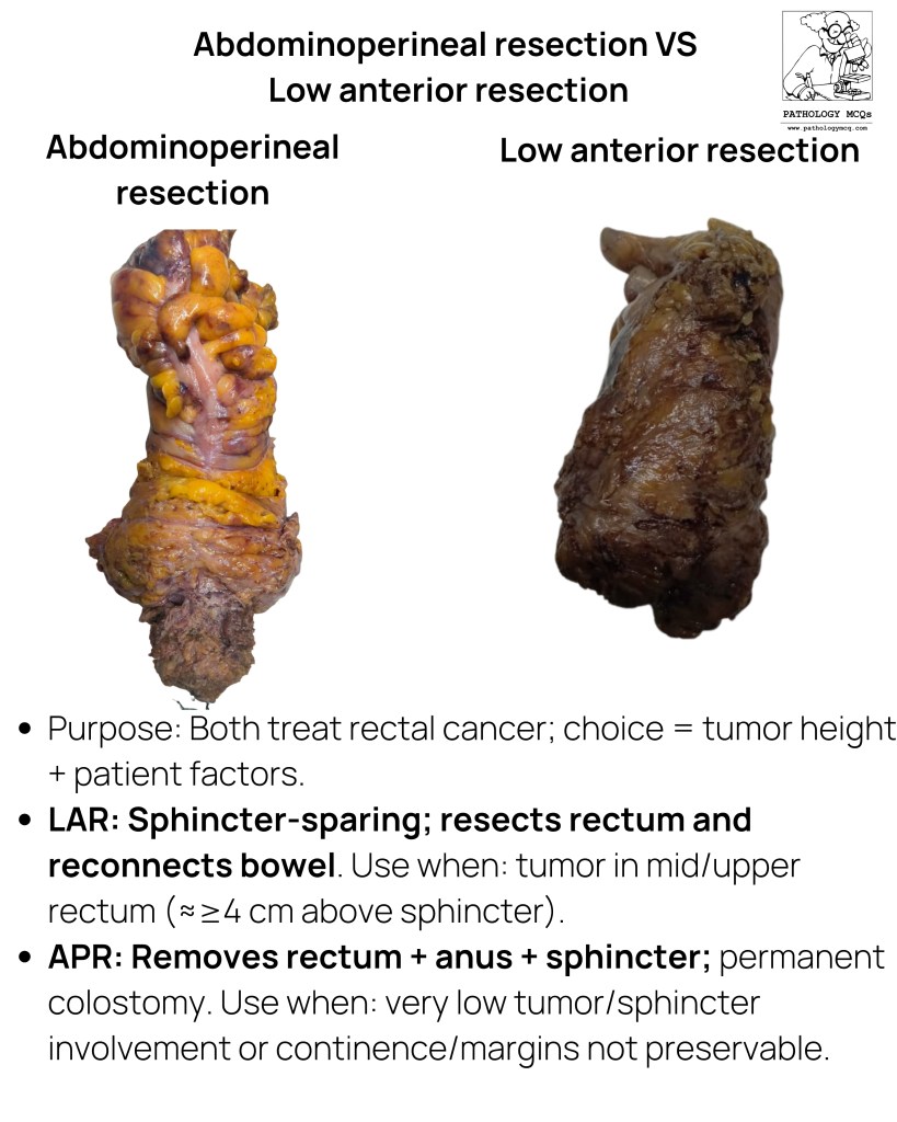 🧾 Gross Pearls: Anatomy & Surgical Resection of the Rectum - PATHOLOGY MCQs
