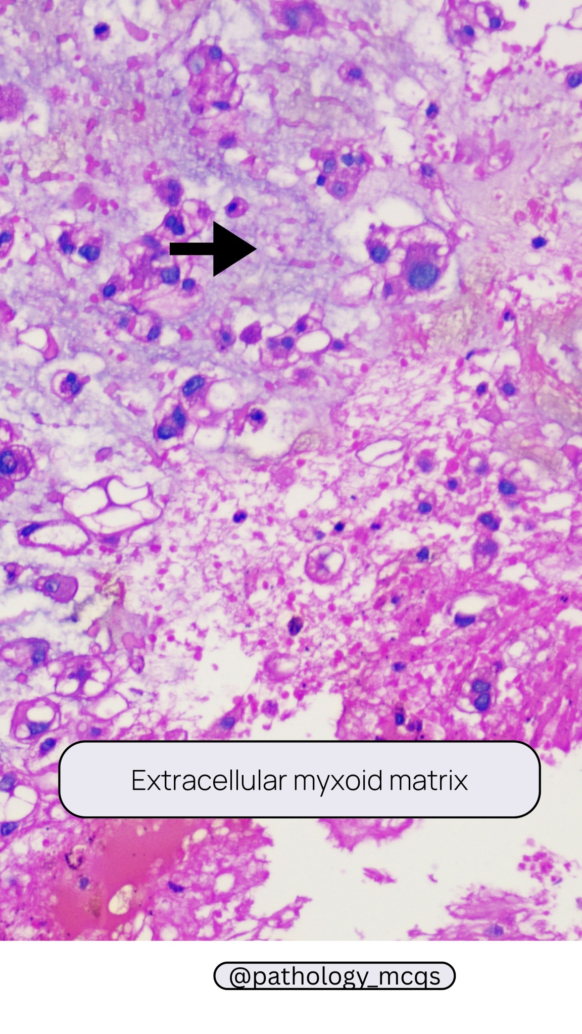Understanding Chordoma: Diagnosis and Pathology - PATHOLOGY MCQs