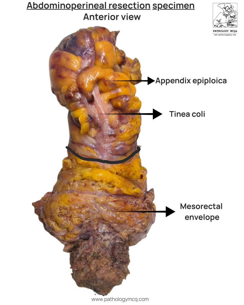 Understanding Rectal Surgery: LAR vs APR Explained
