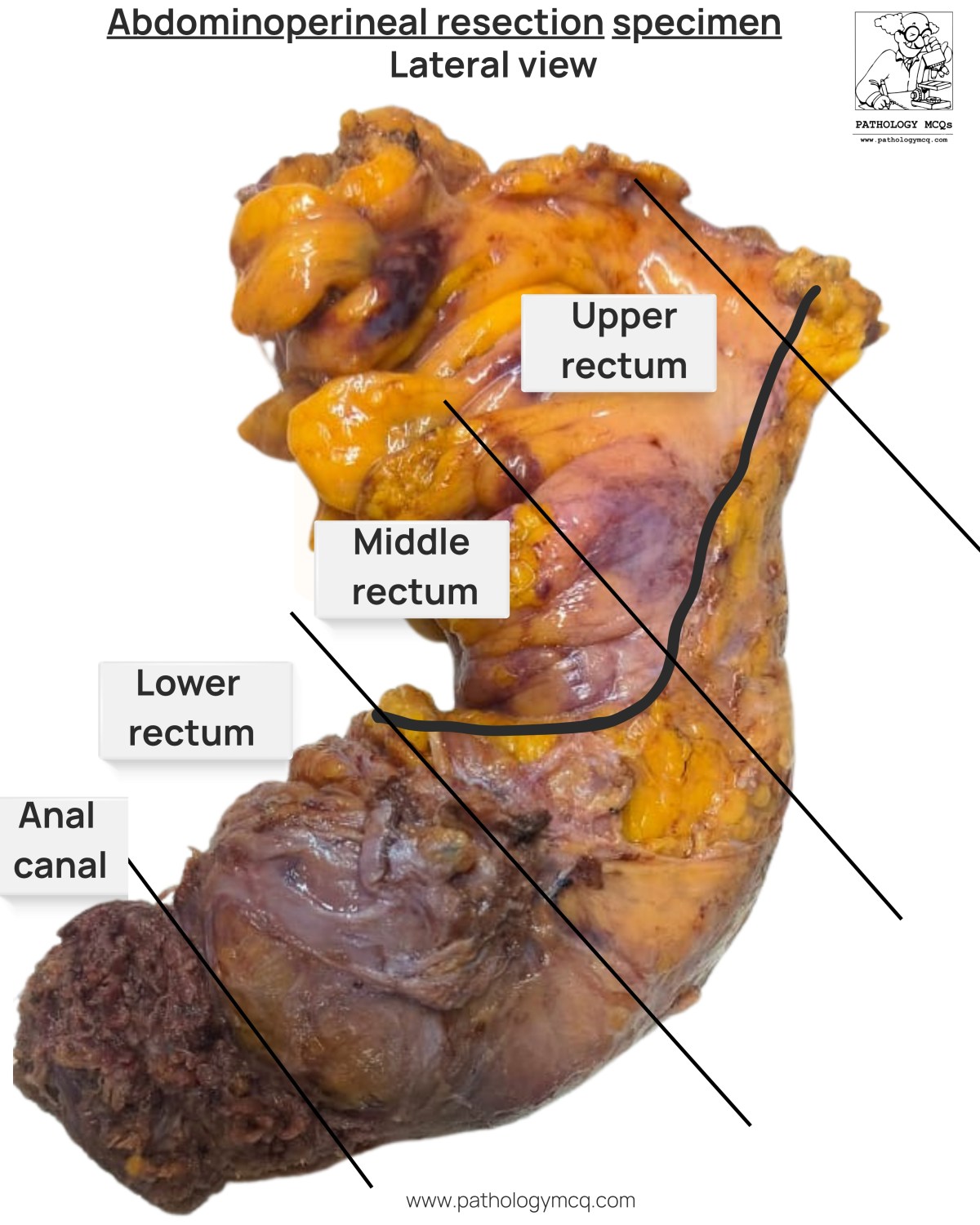 🧾 Gross Pearls: Anatomy & Surgical Resection of the Rectum - PATHOLOGY MCQs