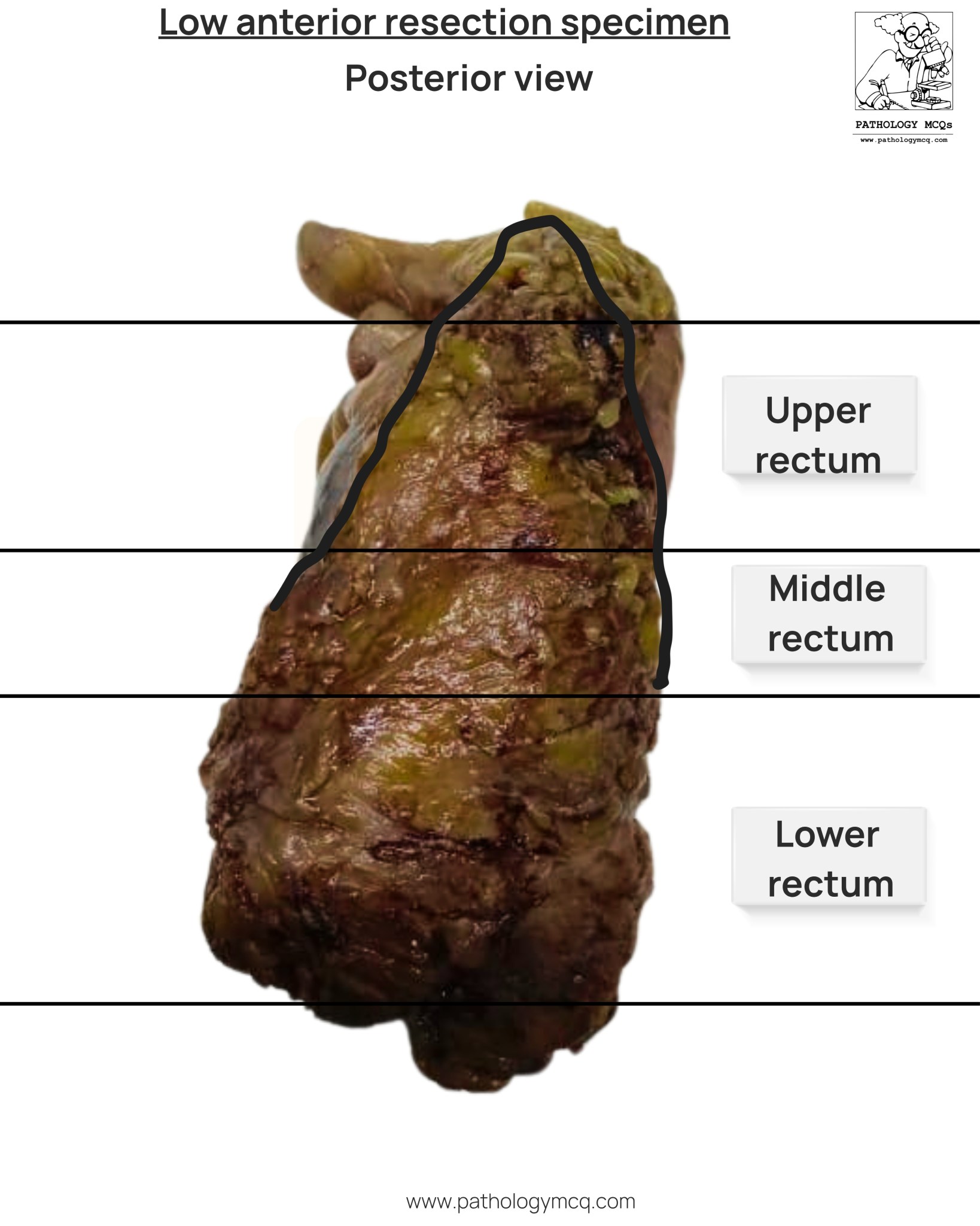 🧾 Gross Pearls: Anatomy & Surgical Resection of the Rectum - PATHOLOGY MCQs