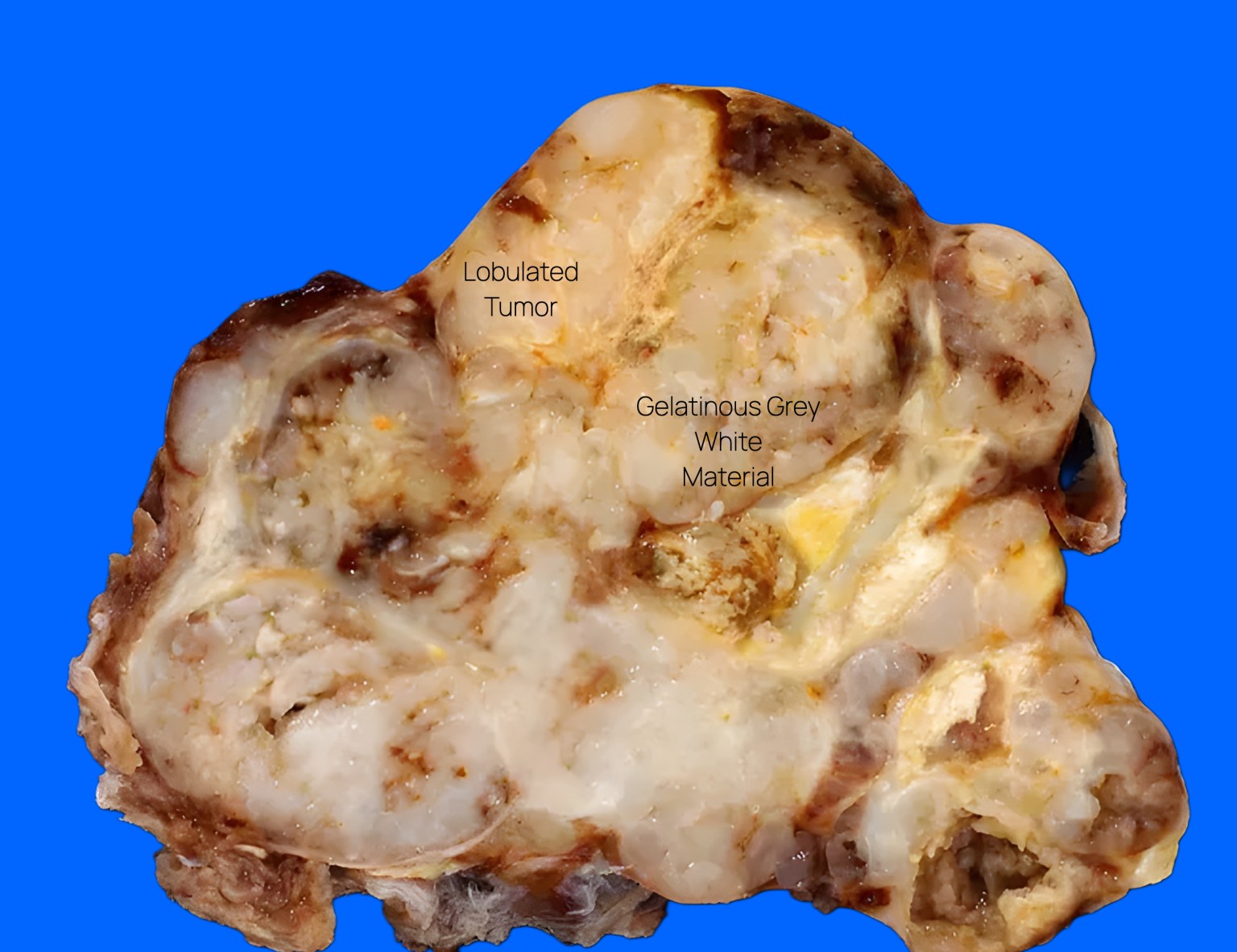 Understanding Chordoma: Diagnosis and Pathology - PATHOLOGY MCQs