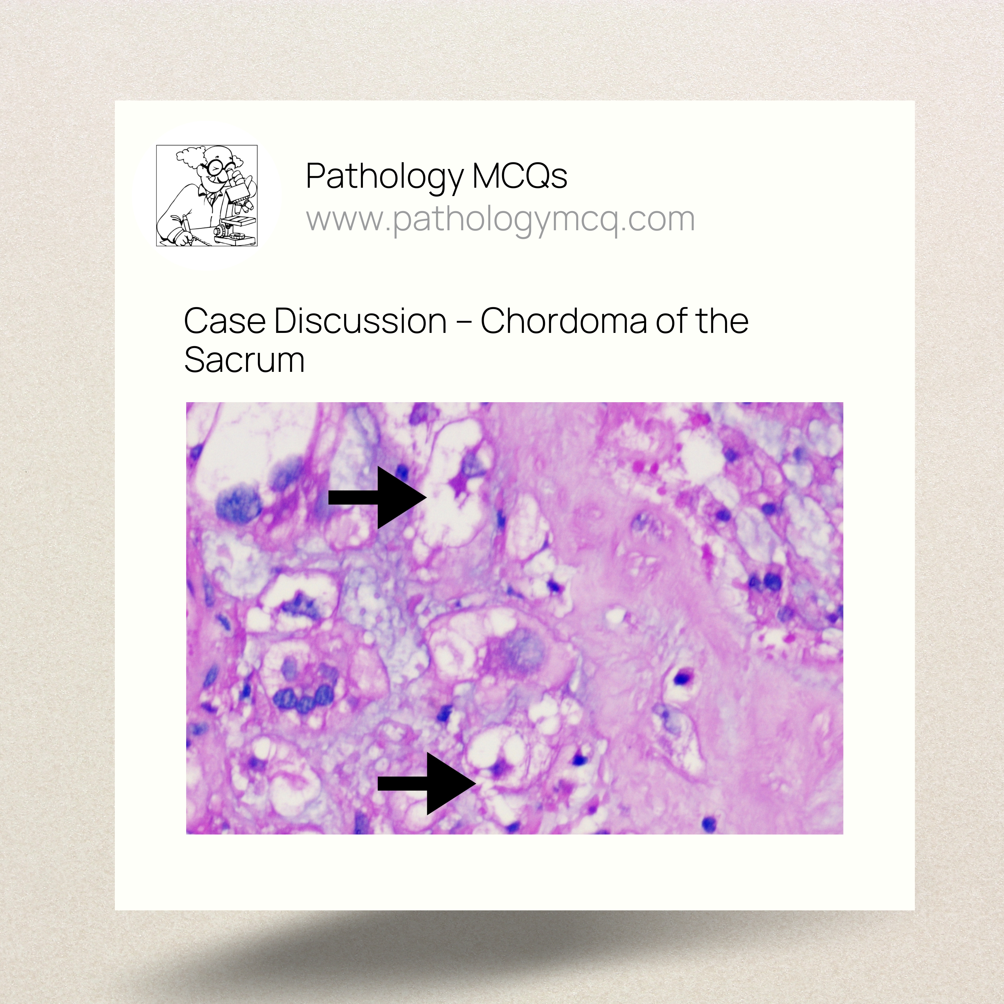 Understanding Chordoma: Diagnosis and Pathology - PATHOLOGY MCQs