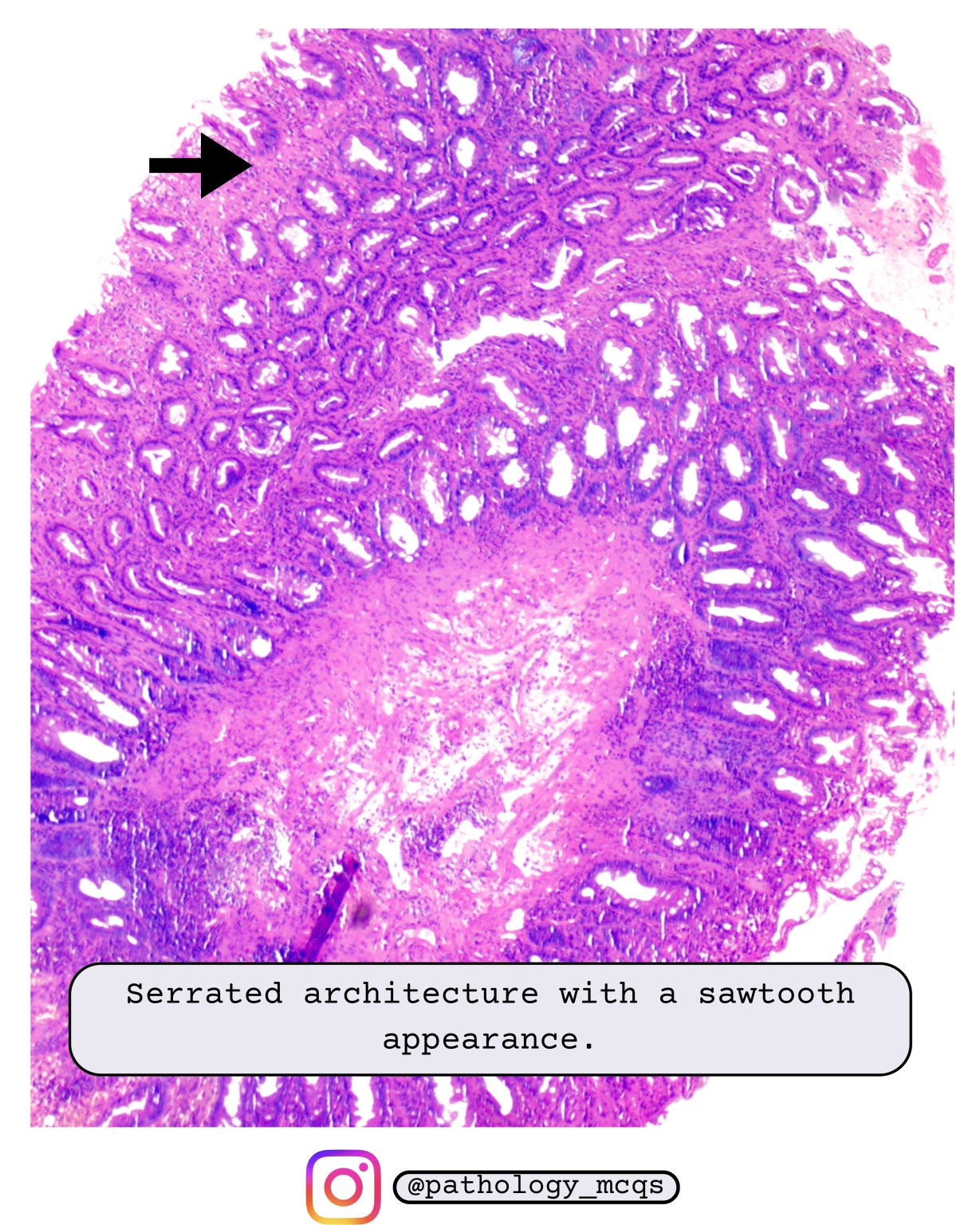 Hyperplastic Polyp Pathology: Histology, Diagnosis, MCQs & Differentiation