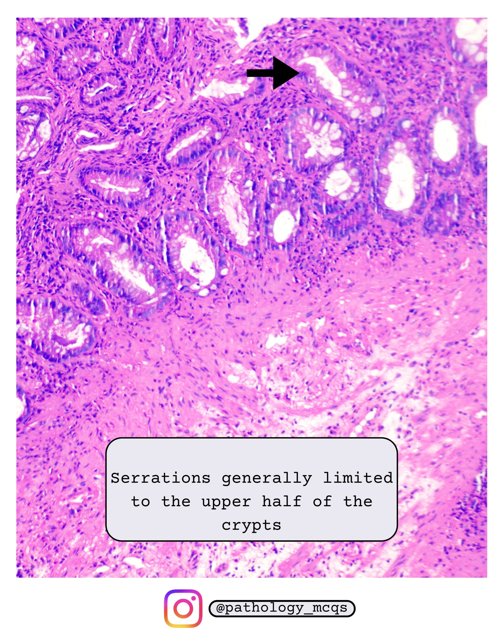 Hyperplastic Polyp Pathology: Histology, Diagnosis, MCQs & Differentiation