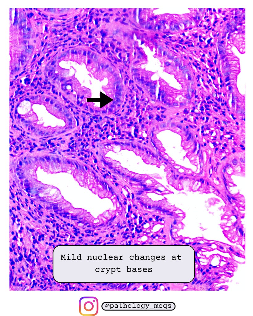 Hyperplastic Polyp Pathology: Histology, Diagnosis, MCQs & Differentiation