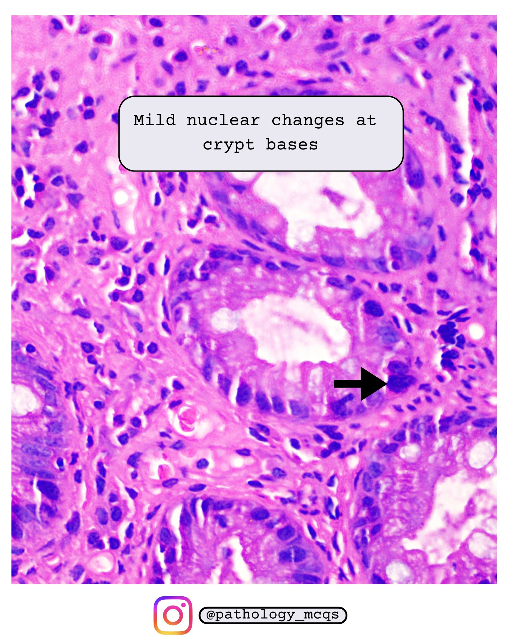 Hyperplastic Polyp Pathology: Histology, Diagnosis, MCQs & Differentiation